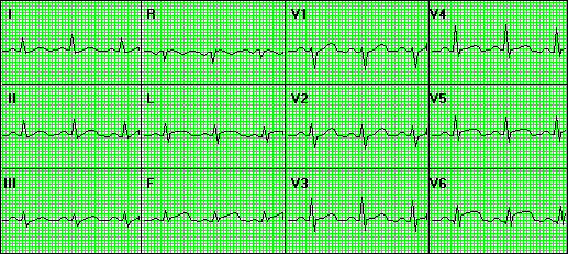 Myocardial Infarction Lateral Myocardial Infarction Ecg